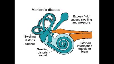 Meniere's Treatment | Best ENT Specialist | Dr. Seemab Shaikh